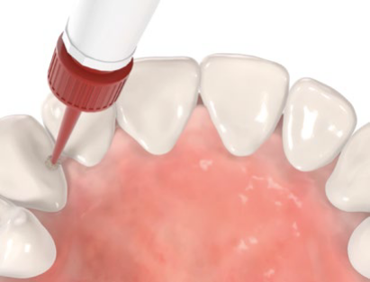 memotain | uportho.com 2025