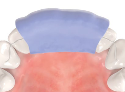 memotain | uportho.com 2025