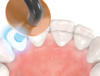 memotain | uportho.com 2025